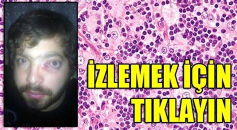 Gözündeki şişlik hayatını kararttı Son Dakika Haberleri Milliyet