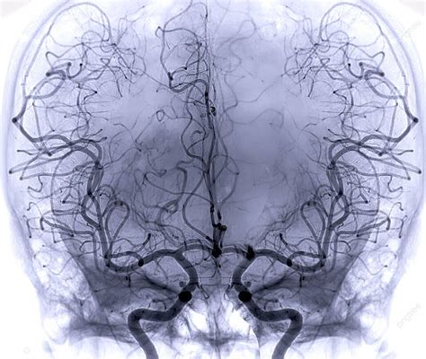 Fluoroscopy Intervention Radiology Image Revealing Cerebral Artery