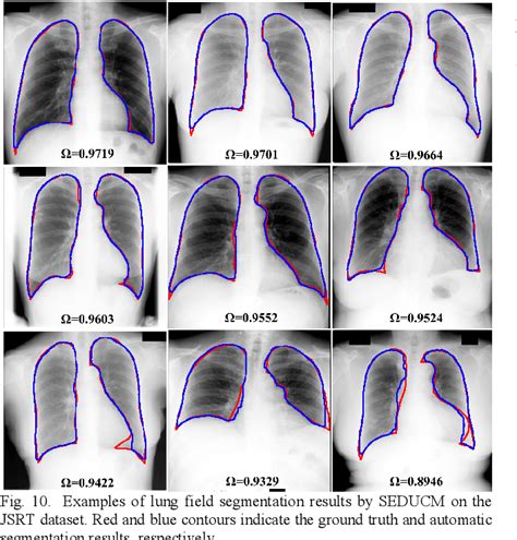 figure 10 from lung field segmentation in chest radiographs from boundary maps by a structured