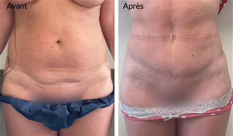 Cicatrices après abdominoplastie Comment les cacher Dr HADDAD