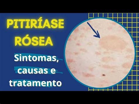 Topo Imagem Pitiriase Rosa Br Thptnganamst Edu Vn