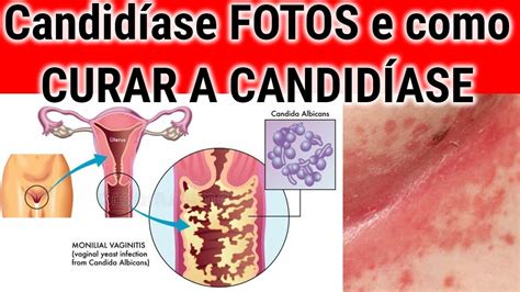 Candidíase Fotos e como tratar e curar a Candidíase Fotos YouTube