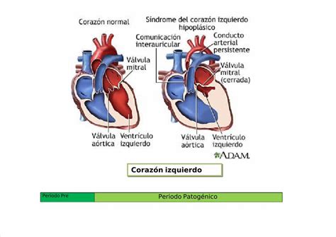 PDF Corazon Izquierdo Hipoplásico DOKUMEN TIPS