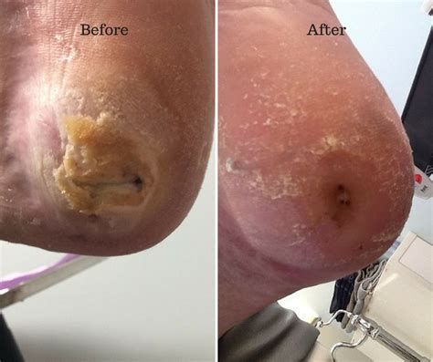 Wounds Foot And Ankle Wellness Centre