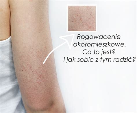 Czerwone Krostki Na Ramionach I Udach Brzmi Znajomo Co To Jest