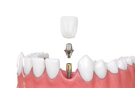 7 Reasons To Get Dental Implants Pascack Dental Arts