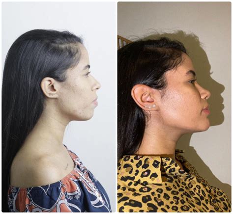 Você sabe o que são cirurgia ortognática e cirurgião bucomaxilofacial