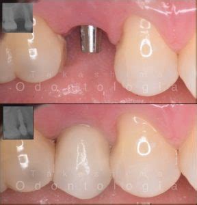 O que são implantes dentários Dr Marcos Takashima