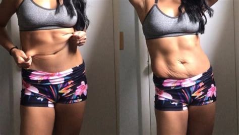 Loose Skin After Weight Loss Does It Go Away Heres How You Can Get