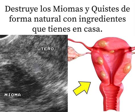 REMEDIOS NATURALES PARA ELIMINAR LOS MIOMAS Y QUISTES Remedios Caseros