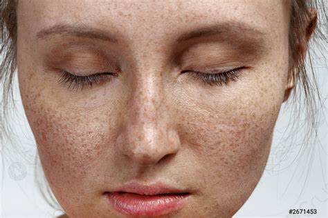 Manchas Pecas y Lunares MED Medicina Estética