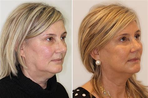 Estímulo de Colágeno Um guia comparativo entre Fios de PDO Sculptra
