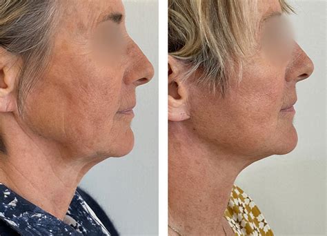Photos avant après de Lifting CervicoFacial Lyon Dr Gebert Chirurgie