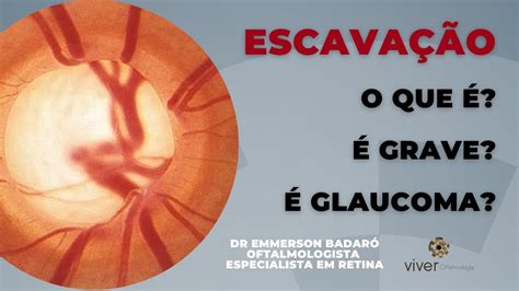 O que é escavação do nervo Dr Emmerson Badaró Viver oftalmologia