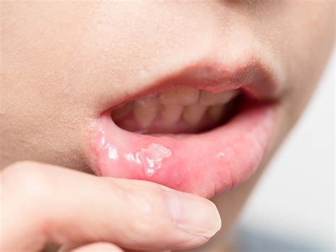Pictures Of Early Signs Of Tongue Cancer Infoupdate Org
