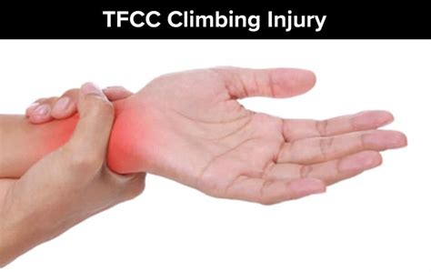 TFCC Injury A Common Source Of Wrist Pain In Climbers The Climbing