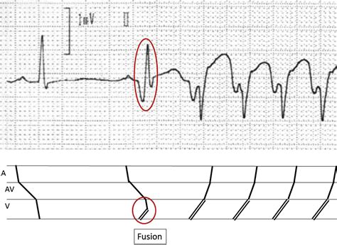 General Approach To A Wide Qrs Complex Cardiac Electrophysiology Clinics