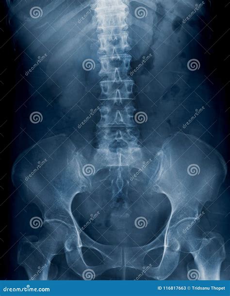 Imagen Lumbar De La Radiograf A De La Espondilosis Imagen De Archivo