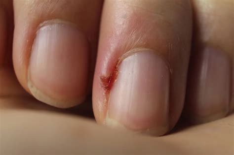 Padrastros en los dedos Aquí te damos las causas prevención y cuidados