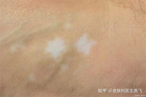 早期白癜风有什么表现 知乎