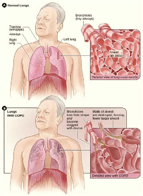 Chronic Obstructive Pulmonary Disease Copd From Usa National Heart