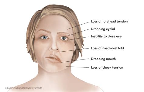 Ramsay Hunt Syndrome Explained By Dr Amit Kochhar Pacific