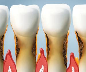 Qué es la piorrea Causas síntomas y tratamientos Centro Dental