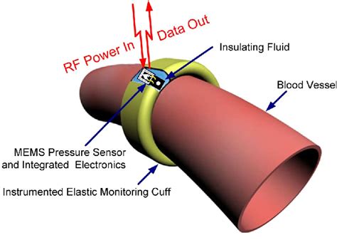 A Wireless And Batteryless 10 Bit Implantable Blood Pressure Sensing