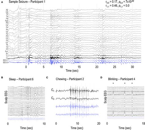 frontiers seizure forecasting using a novel sub scalp ultra long term eeg monitoring system