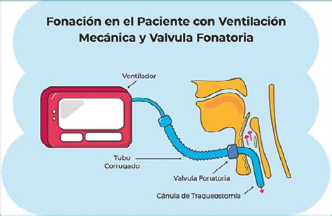 Estrategias de comunicación verbal en el paciente con traqueostomía