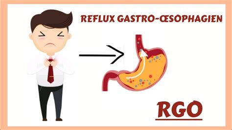 Le Reflux Gastro œsophagien RGO physiopathologie diagnostic