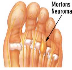 Morton S Neuroma Podiatrist San Antonio Podiatrist Austin