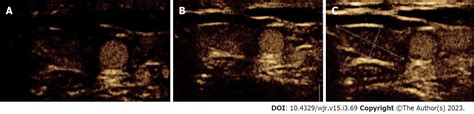 Multi Modality Parathyroid Imaging A Shifting Paradigm