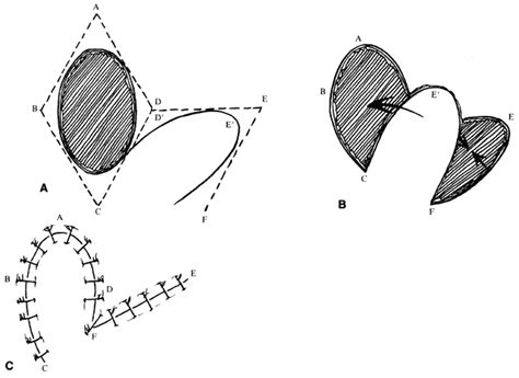 Transposition Flap