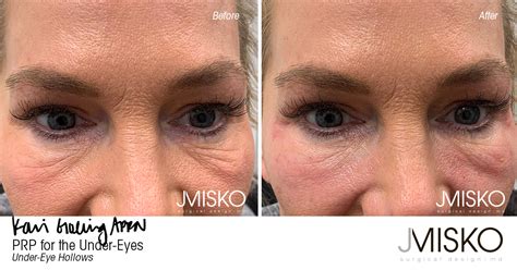 PRP Under Eye Treatment JMISKO