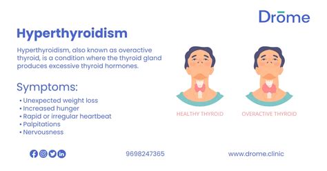 Hyperthyroidism Causes Symptoms Treatment Drome Clinic