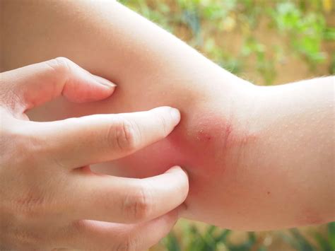 Common Bug Bites What To Do About Them Arlington Dermatology