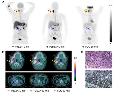 New Pet Probe Could Improve Detection Of Primary And Metastatic Melanoma