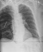 Pneumothorax Radiographie Pulmonaire