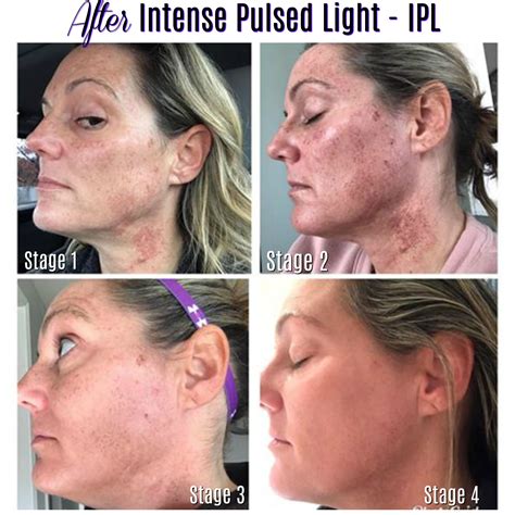 Remove Age Spots Broken Capillaries With Ipl Therapy Off