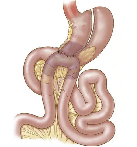 One Anastomosis Gastric Bypass Treatment Kogarah