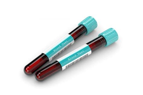 Cosa Significano I Risultati Degli Esami Del Sangue Salus It
