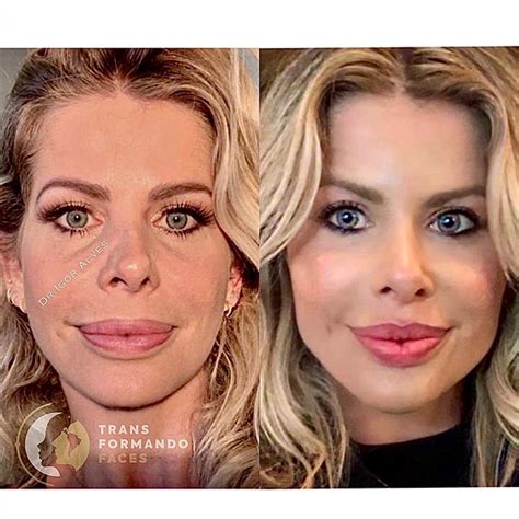 Cirurgião mostra antes e depois do preenchimento nos lábios de Karina
