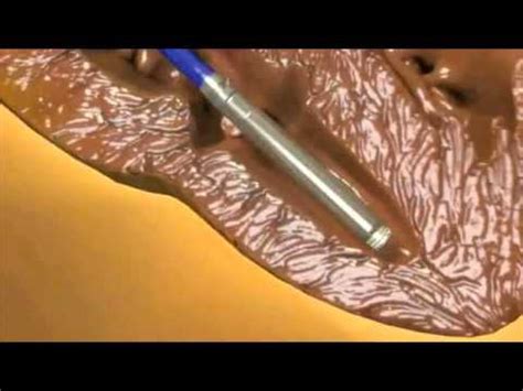 Leadless Cardiac Pacemaker NEJM YouTube