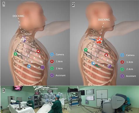 1 2 The Incision And Instrument Arm Placement Depended On The