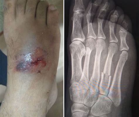 4th Metatarsal Fracture