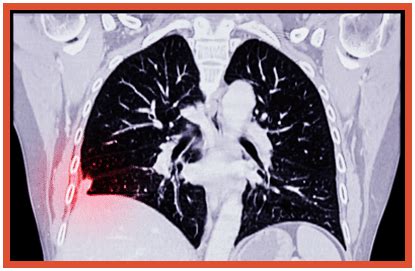 IMV Spotlight Low Dose CT Lung Cancer Screening Programs IMV Medical