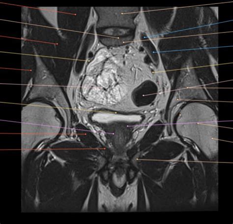 Male Pelvis Coronal MRI 6 Diagram Quizlet