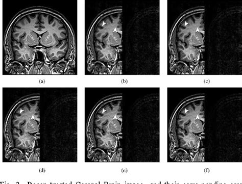 figure 2 from bregman iteration based efficient algorithm for mr image reconstruction from