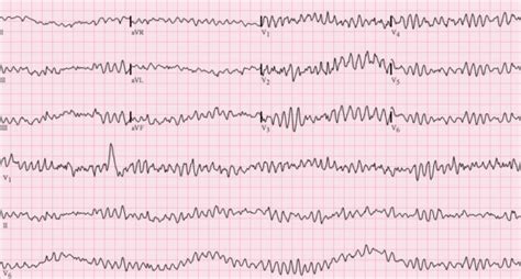 Tratamiento De La Taquicardia Fibrilaci N Ventricular